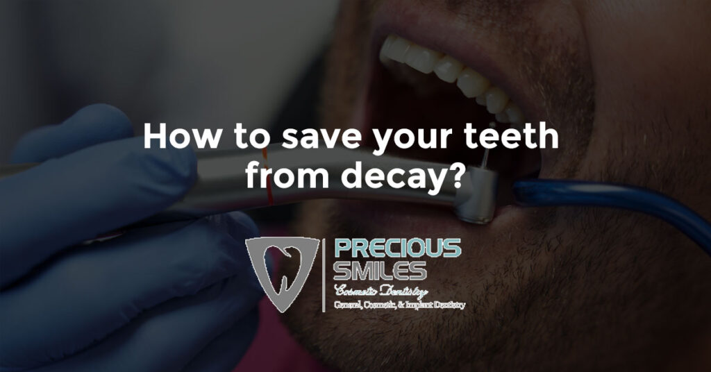How to save your teeth from decay? - Cosmetic Dentistry in Miami ...